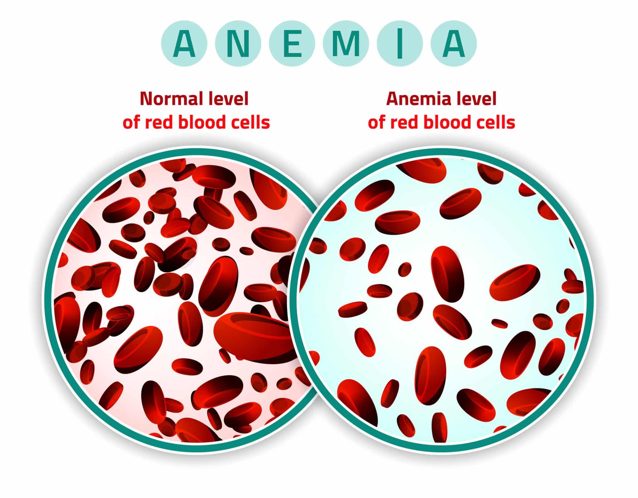 Flying With Anemia Iron Deficiency Anemia Evaluation And Management