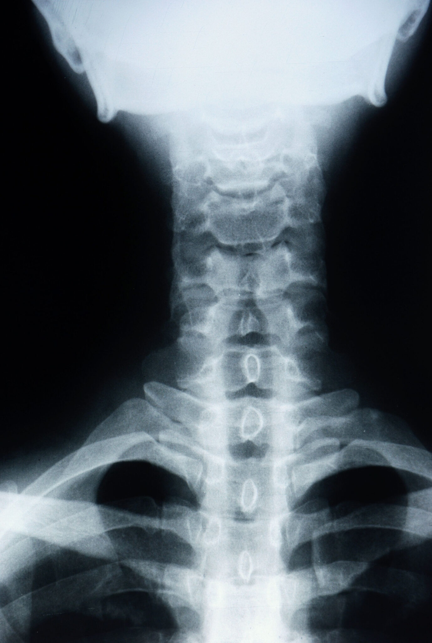 Neck Surgery After Car Accident | Post Accident Neck Surgeries